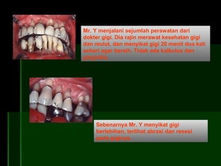 Karies dan gingivitis | PPT