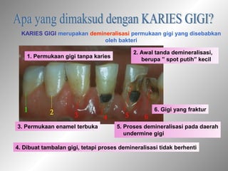 Karies dan gingivitis | PPT