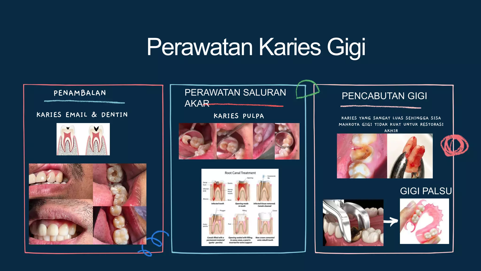 Karies Gigi by Drg. Andi Dini.pptx