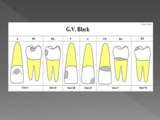 Kariesi i dhëmbit | PPTX