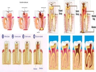 Kariesi i dhëmbit | PPTX