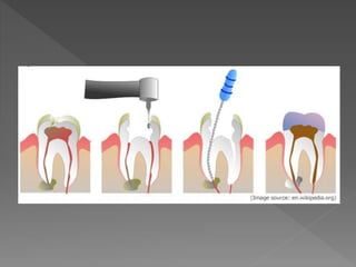 Kariesi i dhëmbit | PPTX