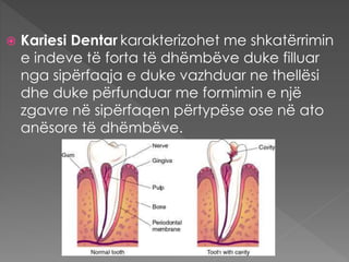 Kariesi i dhëmbit | PPTX