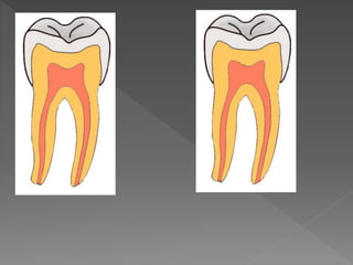 Kariesi i dhëmbit | PPTX