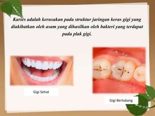 Karies (lubang gigi) | PPTX