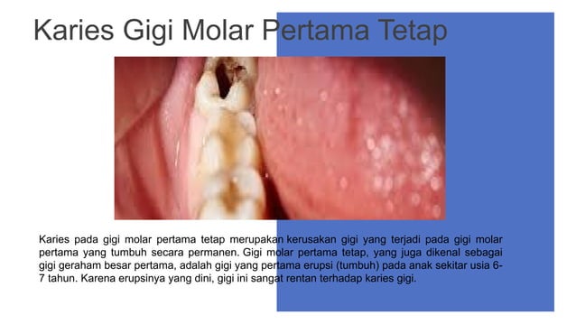 KARIES MOLAR PERTAMA PADA ANAK USIA SD.pptx