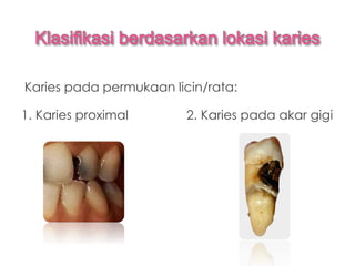 KARIES | PPTX