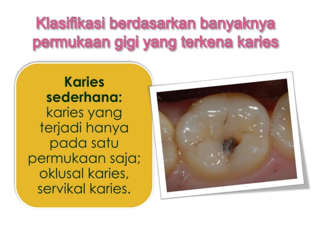 KARIES | PPTX