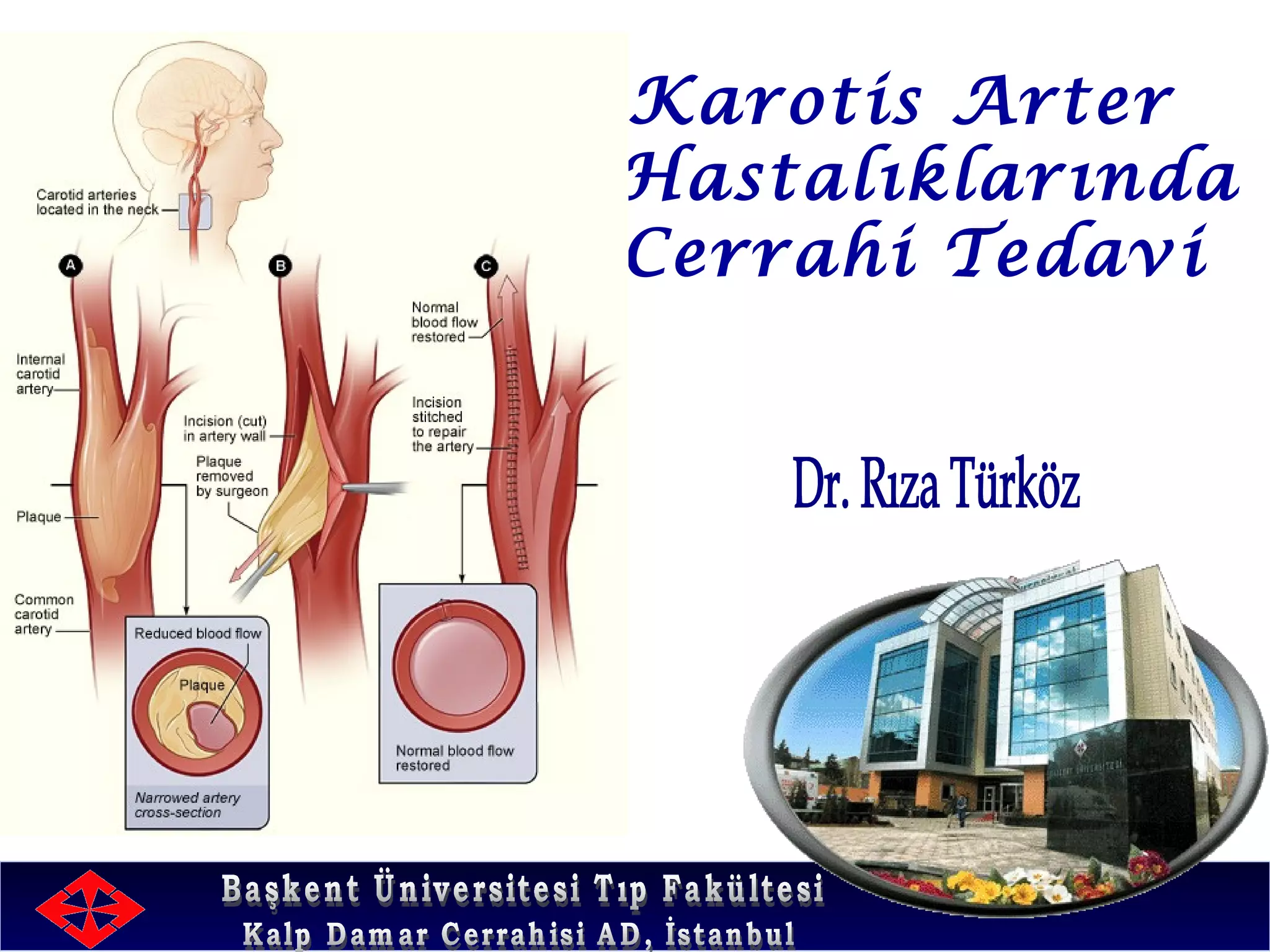 Karotis arter hatalıklarında cerrahi tedavi | PPT