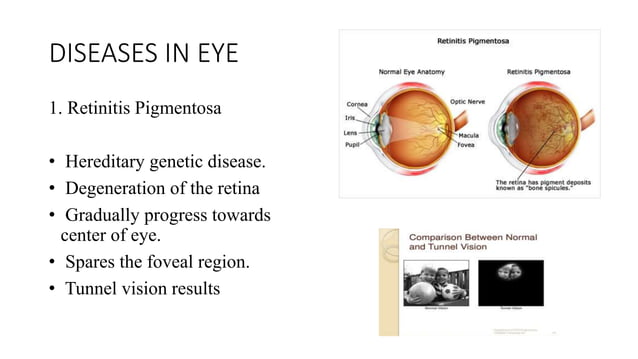 artificial retina | PPT