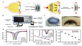 implantable iop sensor | PPTX