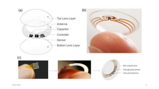 implantable iop sensor | PPTX