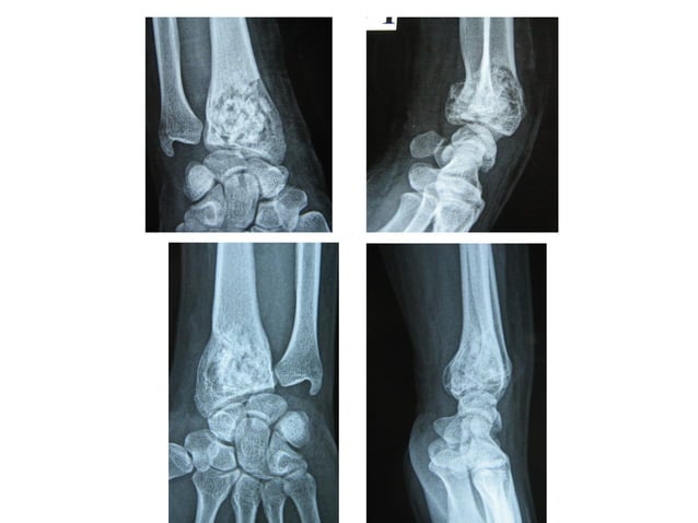 GCT of bone presentation by prof.Ahmad shaheen,M.D. prof.of orthopedic ...