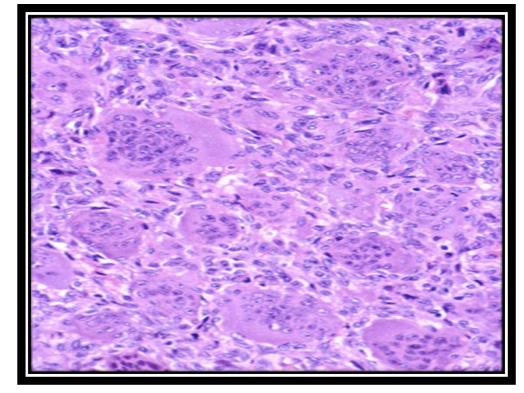 GCT of bone presentation by prof.Ahmad shaheen,M.D. prof.of orthopedi…