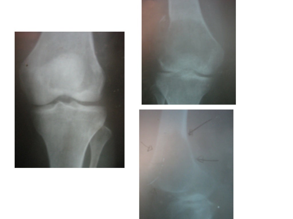 GCT of bone presentation by prof.Ahmad shaheen,M.D. prof.of orthopedi…