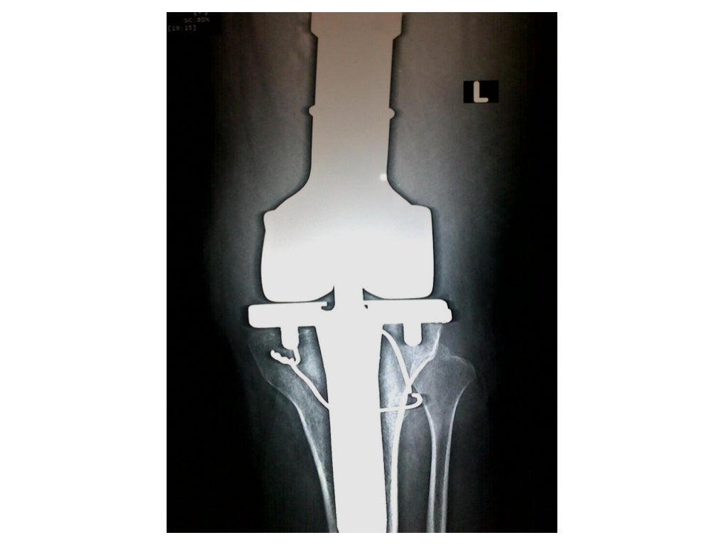 GCT of bone presentation by prof.Ahmad shaheen,M.D. prof.of orthopedi…