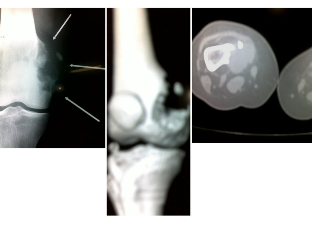 GCT of bone presentation by prof.Ahmad shaheen,M.D. prof.of orthopedi…