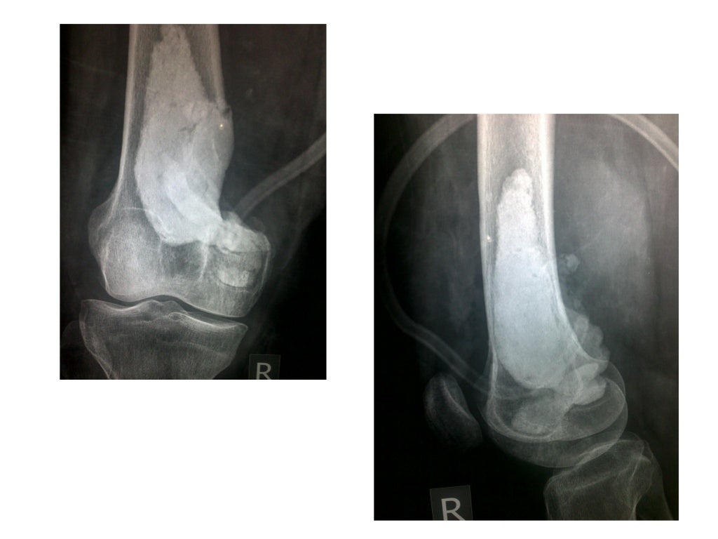 GCT of bone presentation by prof.Ahmad shaheen,M.D. prof.of orthopedi…