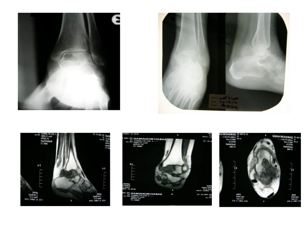GCT of bone presentation by prof.Ahmad shaheen,M.D. prof.of orthopedi…