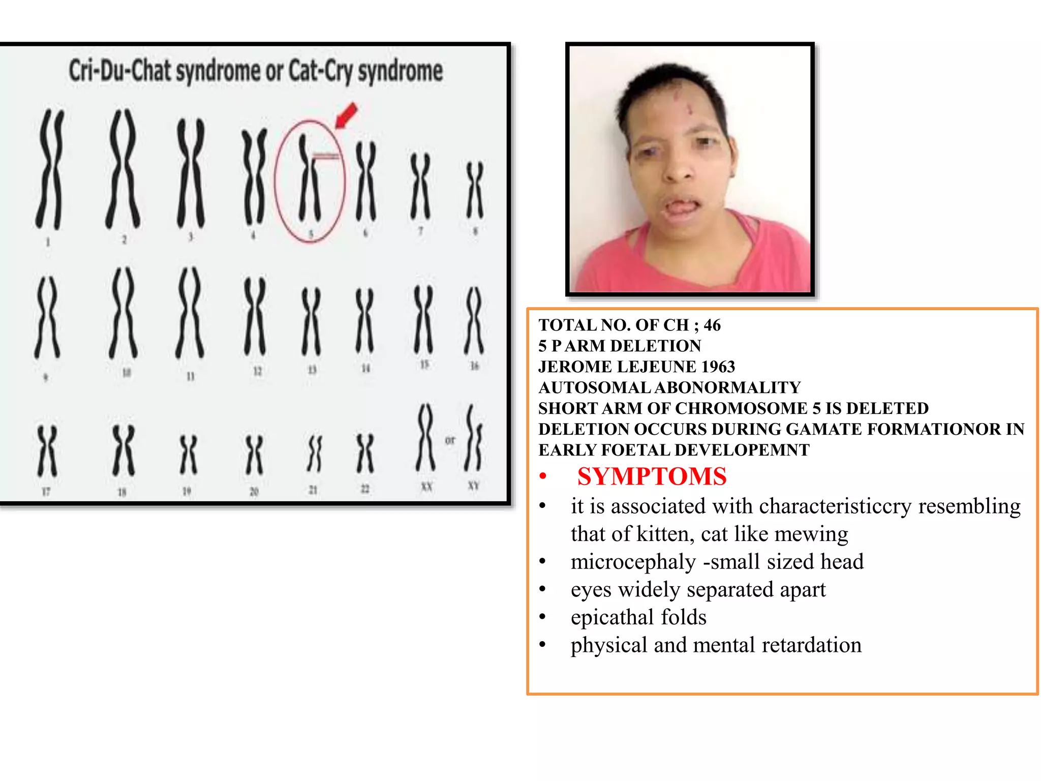 Karyotypic analysis of syndromes, Kilnefelter, Turner , Patau, Edward ...