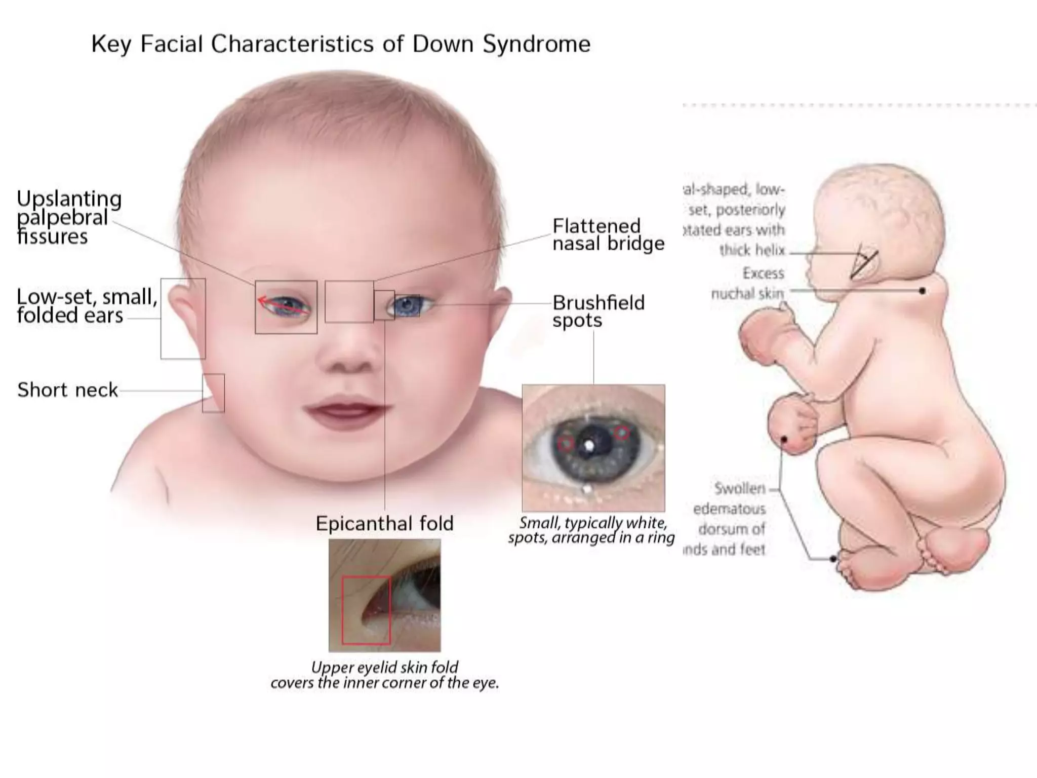 Karyotypes and dysmorphic features | PPT