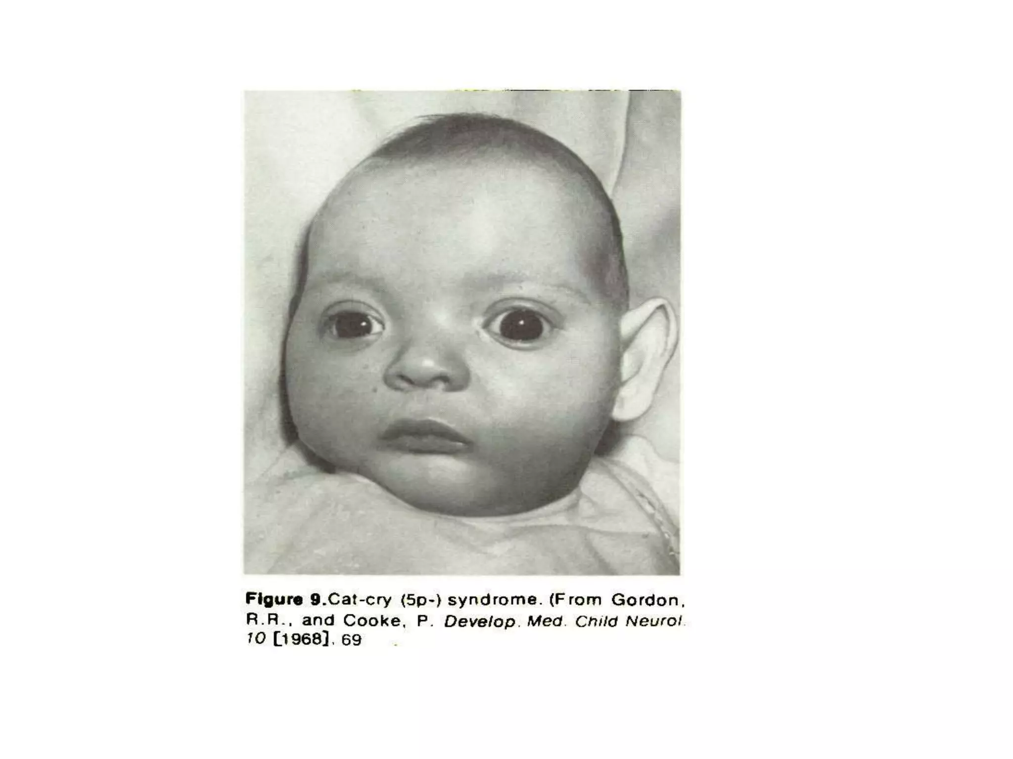 Karyotypes and dysmorphic features | PPT