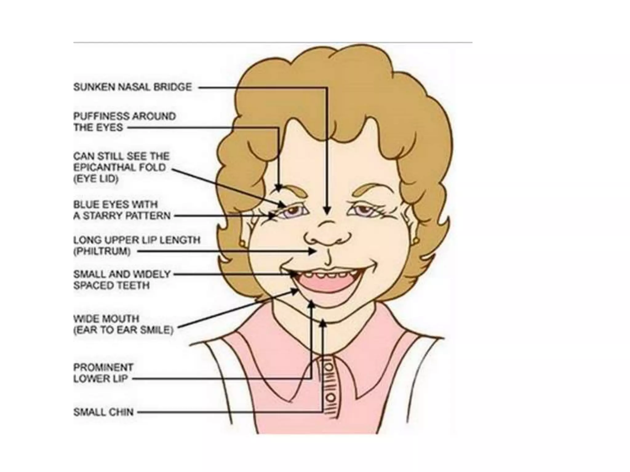 Karyotypes and dysmorphic features | PPTX