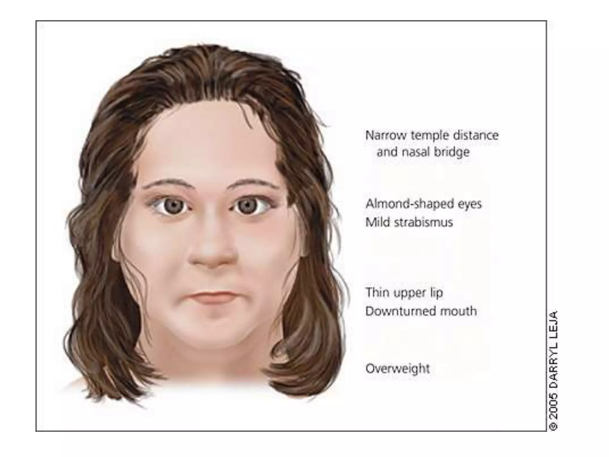 Karyotypes and dysmorphic features | PPTX