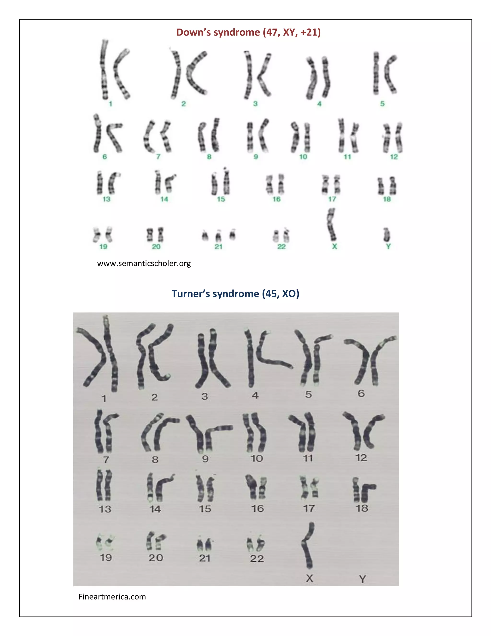 Karyotype in humans with genetic disorders | PDF