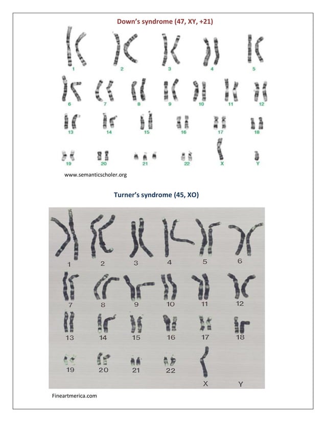 Karyotype in humans with genetic disorders | PDF