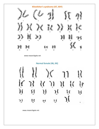 Klinefelter Syndrome Karyotype