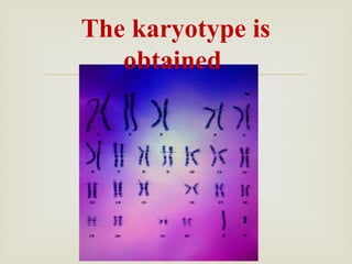 karyotyping.balrog, pediatricsstudy.pptx