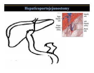 Kasai procedure | PPT