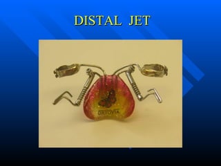 Kasuistika Distal Jet | PPT