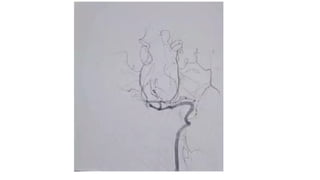 Jurnal reading embolisasi preoperatif. Indikasi dan kompilkas ...