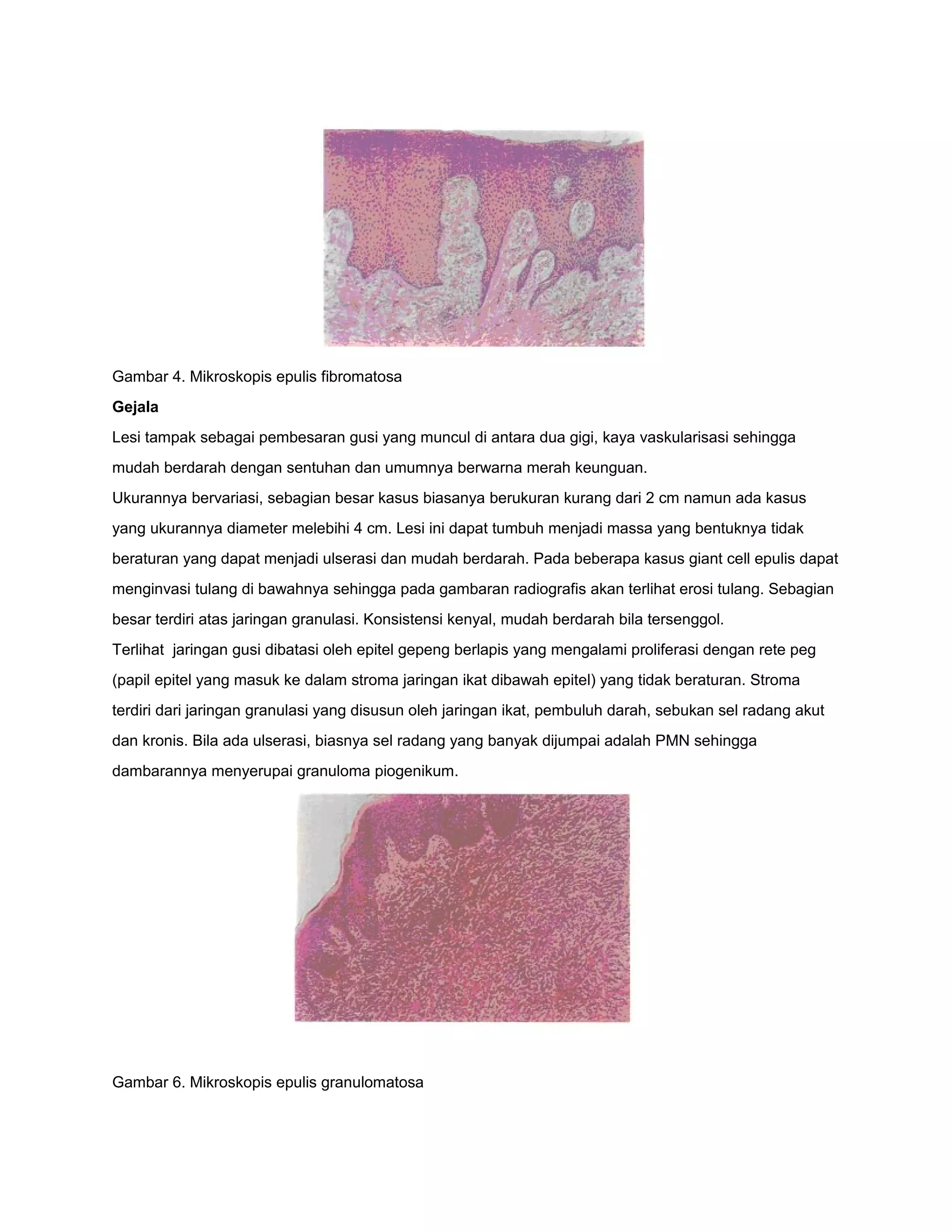 Epulis Fibromatosa ,Clinical Case (Oral surgery) | DOC