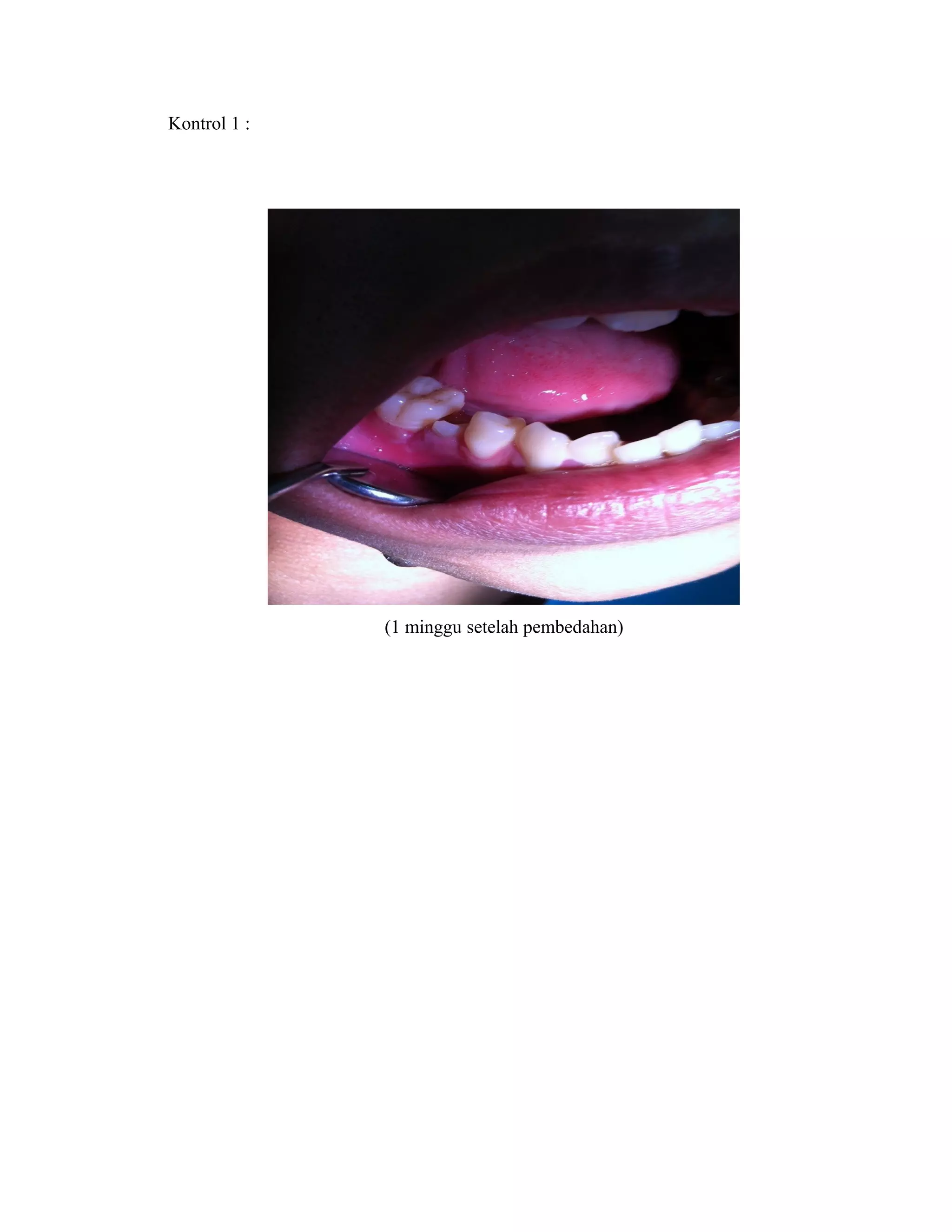 Epulis Fibromatosa ,Clinical Case (Oral surgery) | DOC