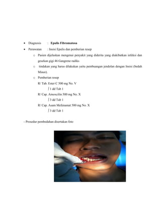 Epulis Fibromatosa ,Clinical Case (Oral surgery) | DOC