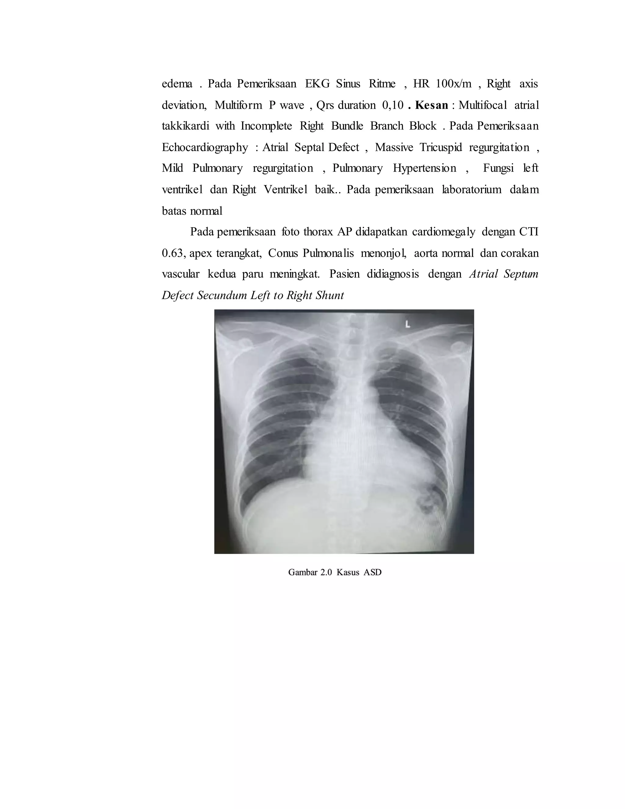 Kasus refarat asd | PDF