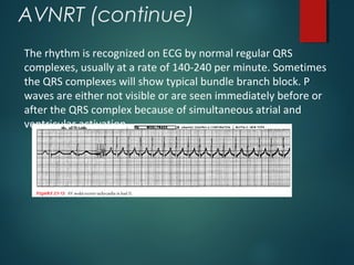 Cardiac Arrhythmias | PPT