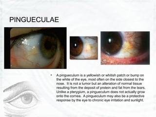 Katarak upt puskesmas bantarsari | PPT