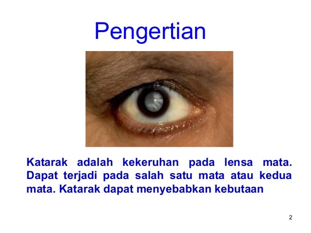 Katarak