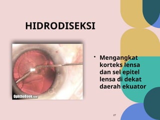 wawasan seputar katarak kongenital pada anak | PPT