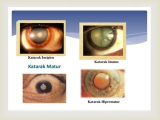 KATARAK SENILIS.pptx ABOUT HEALTHCARE PPT | PPTX