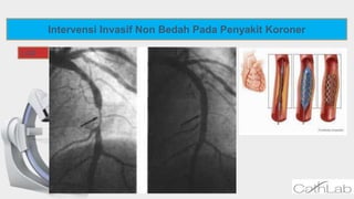 KATETERISASI JANTUNG.pptx