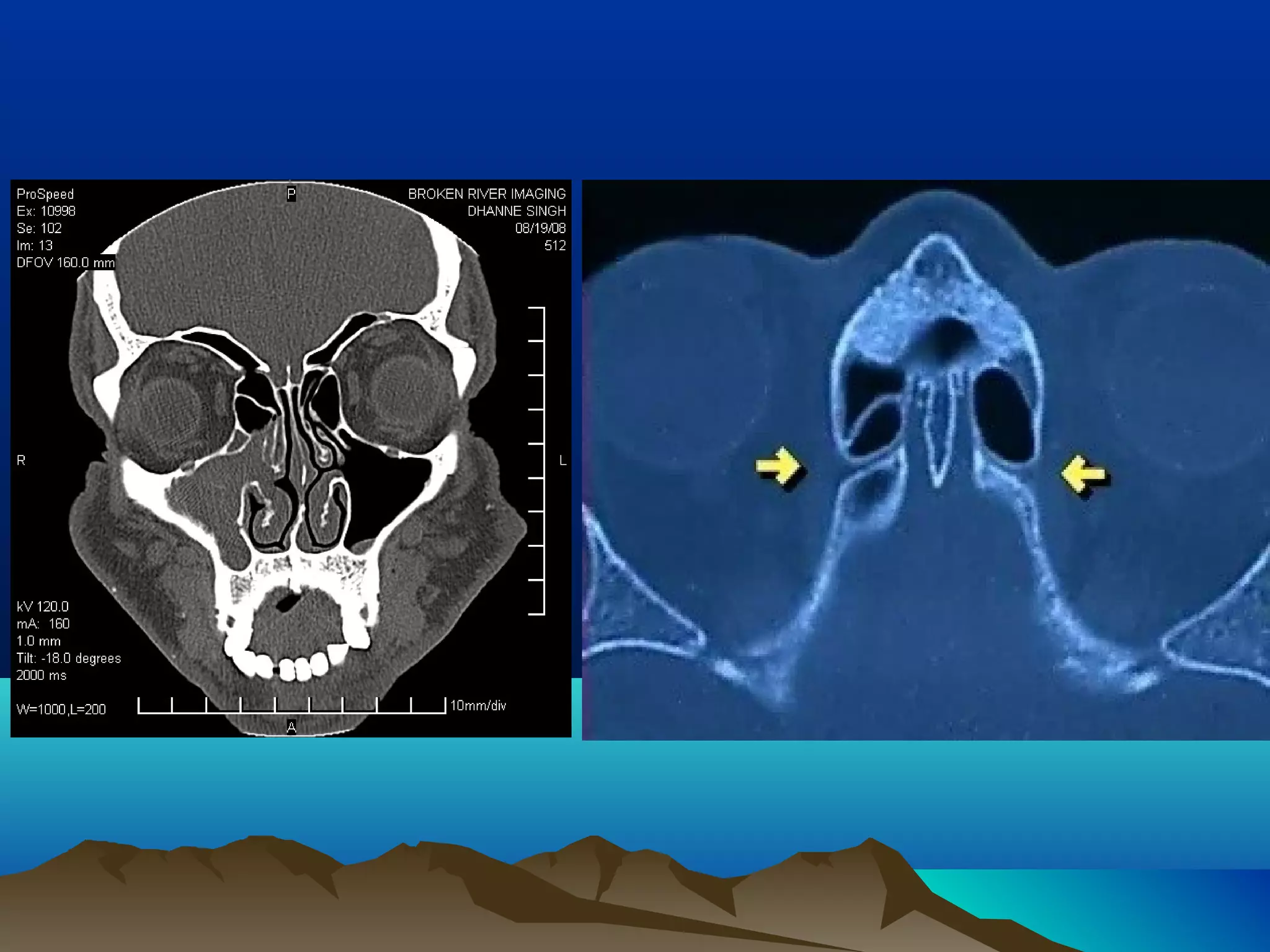 complications fess | PPT