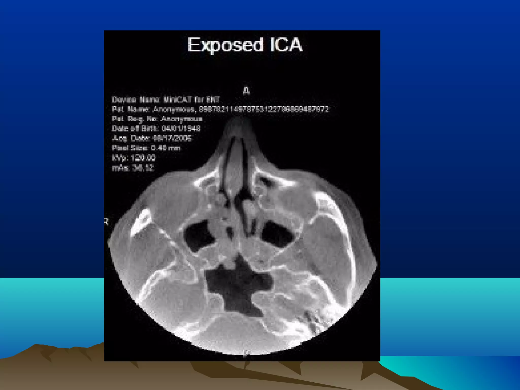 complications fess | PPT