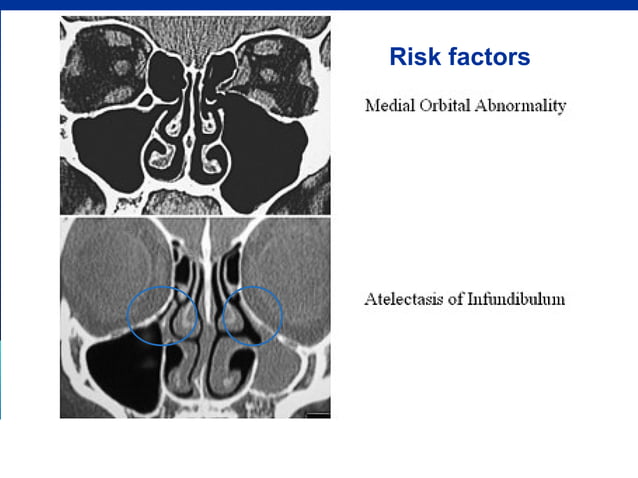 complications fess | PPT | Ear, Nose and Throat Conditions | Diseases ...