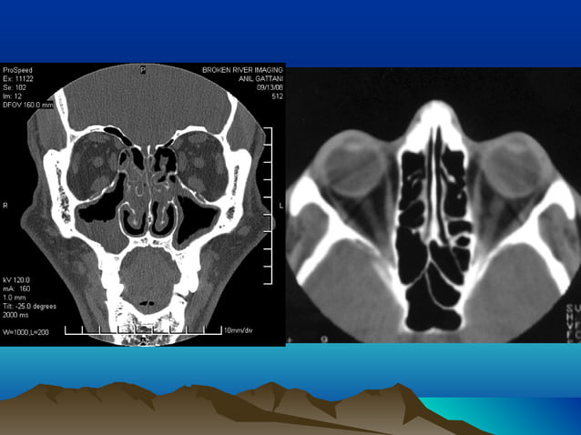 complications fess | PPT | Ear, Nose and Throat Conditions | Diseases ...