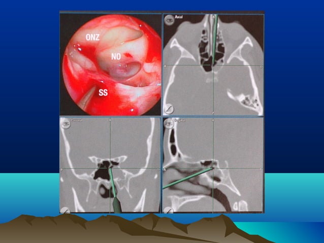complications fess | PPT | Ear, Nose and Throat Conditions | Diseases ...